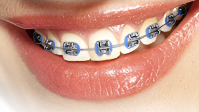Types of Braces | Ashton Orthodontics